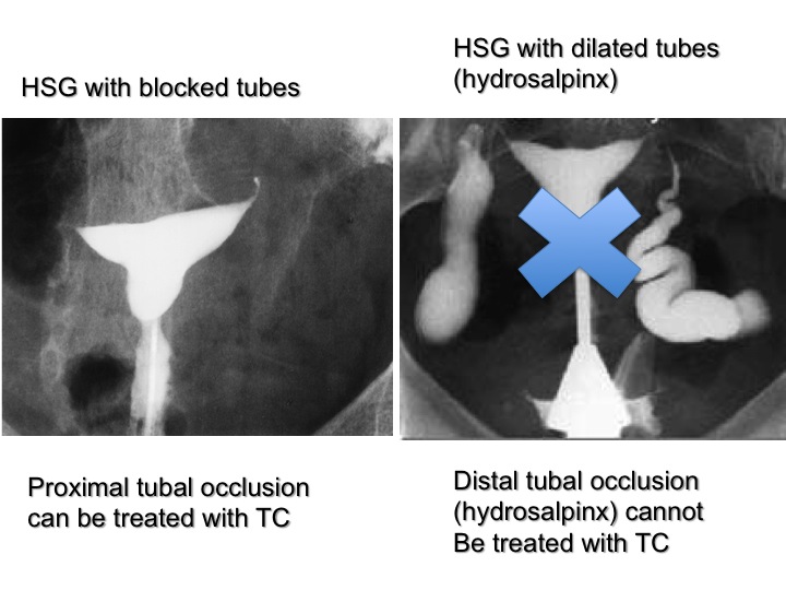 Tubal catheterization (TC): indications and techniques. Part I