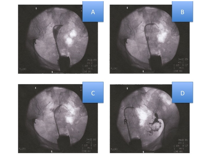 Tubal catheterization – procedure, success rates and risks. Part II.