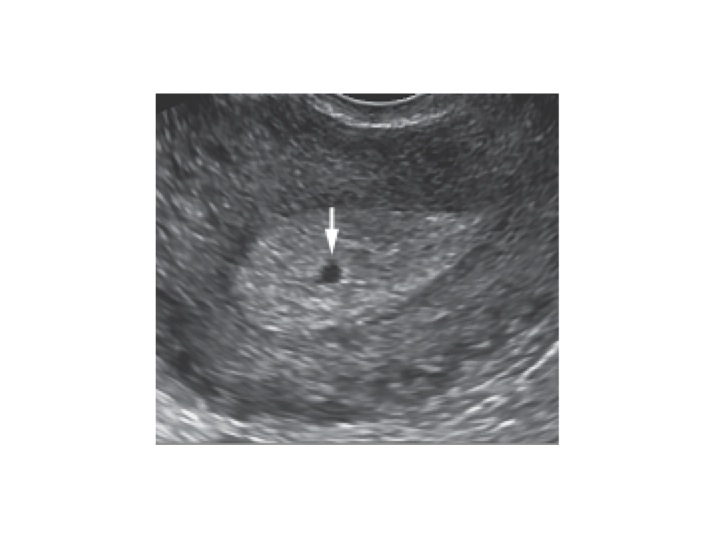 Early pregnancy ultrasound -- Normal pregnancy