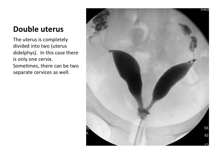 Commonly Seen Uterine Abnormalities on Hysterosalpingography (HSG)