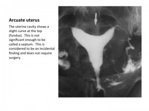 Commonly Seen Uterine Abnormalities on Hysterosalpingography (HSG)