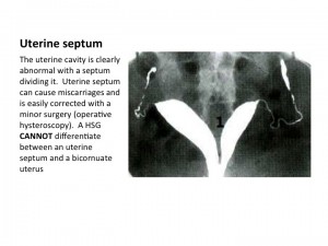 Commonly Seen Uterine Abnormalities on Hysterosalpingography (HSG)