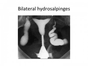 Common Tubal Abnormalities Seen in Hysterosalpingography