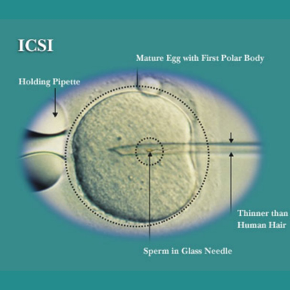 ICSI IVF – What Is It And Why Is It Used?