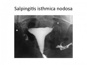 Common Tubal Abnormalities Seen in Hysterosalpingography