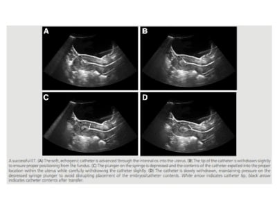 Embryo Transfer: A Critical Step in the IVF Process